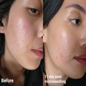 Micro-Needling – Agelessglow